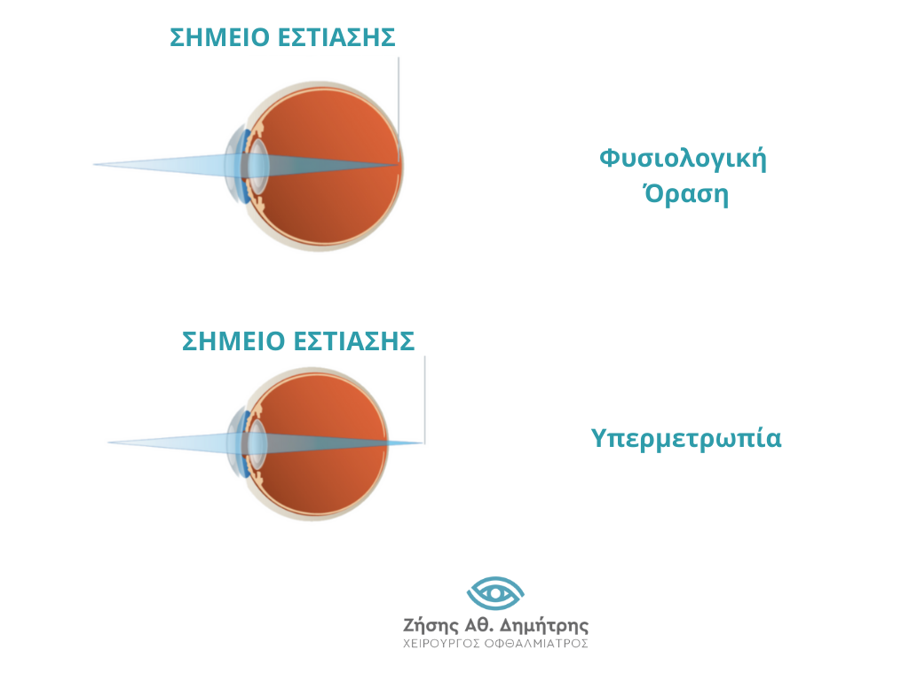 Υπερμετρωπία - Τι είναι, Είδη, Συμπτώματα, Αντιμετώπιση